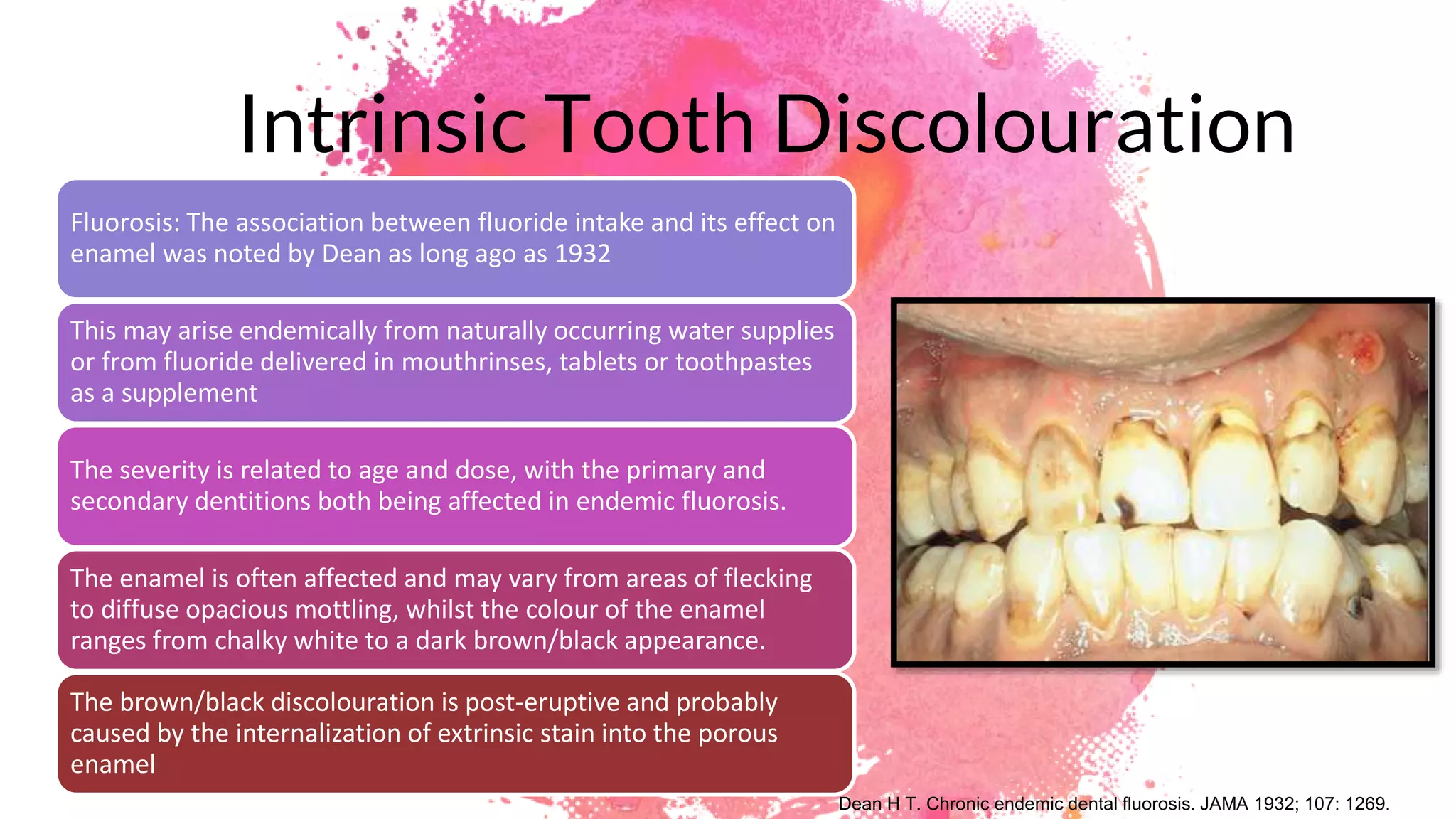 Intrinsic and Extrinsic Discoloration | PPTX