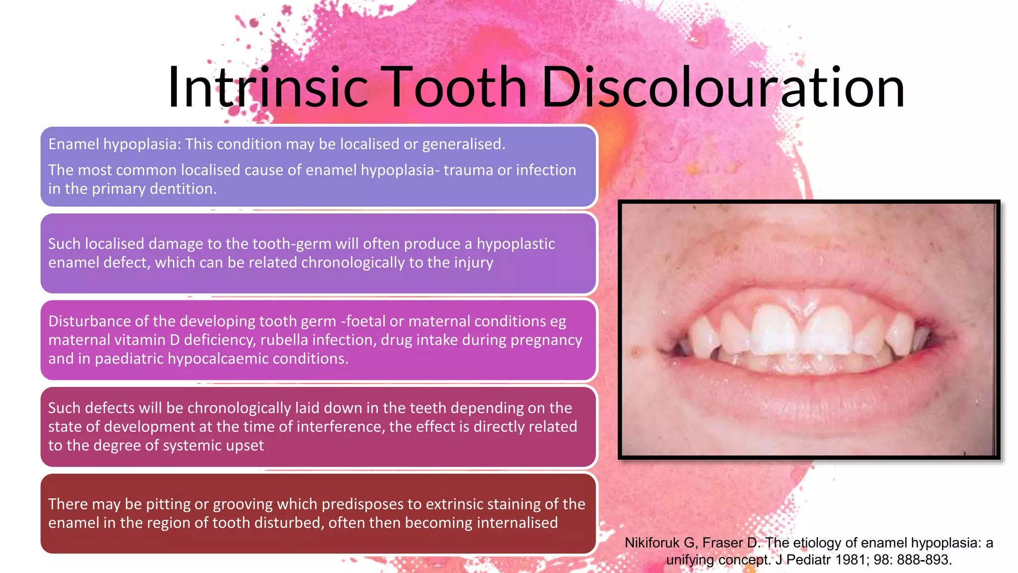 Intrinsic and Extrinsic Discoloration | PPTX