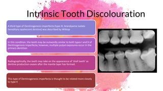 Intrinsic and Extrinsic Discoloration | PPTX