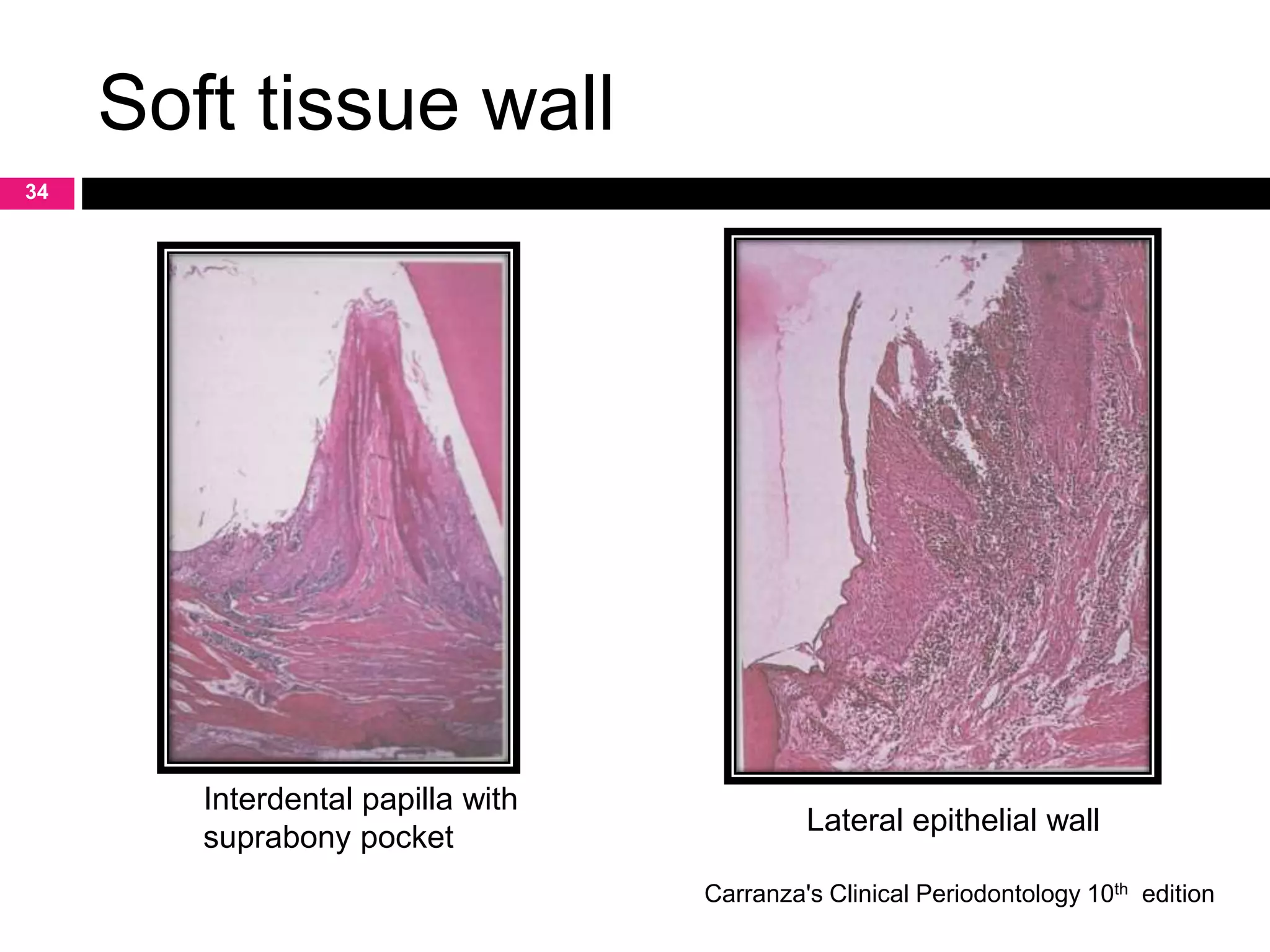 Etiopathogensis of periodontal pocket | PPTX