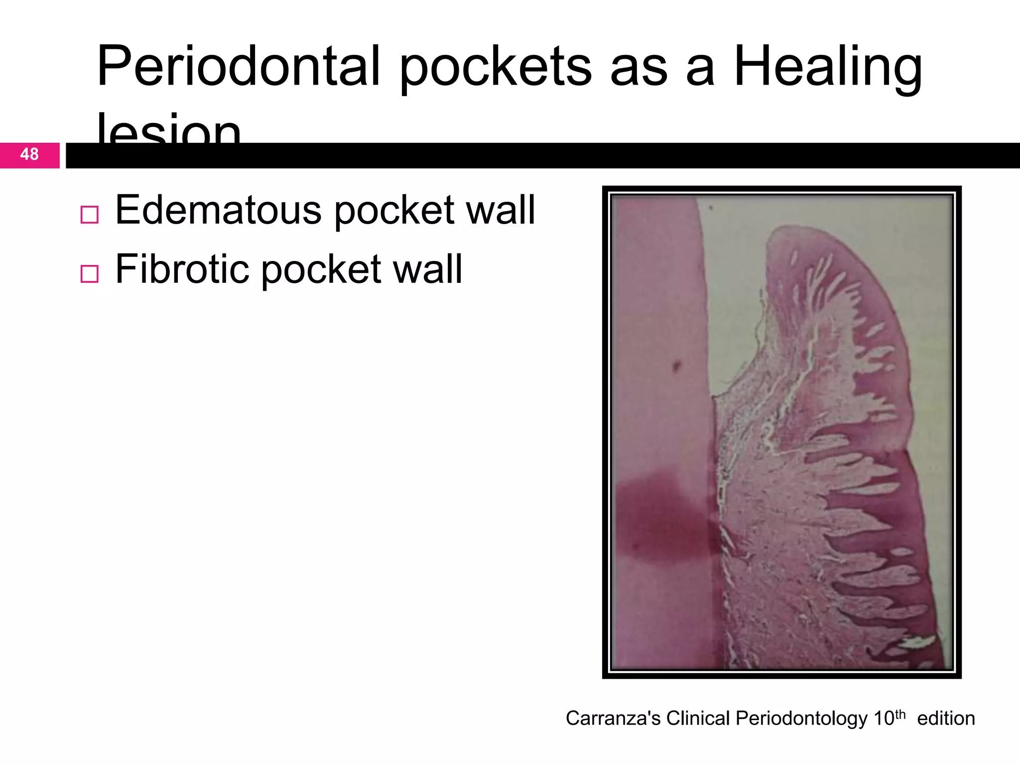 Etiopathogensis of periodontal pocket | PPTX