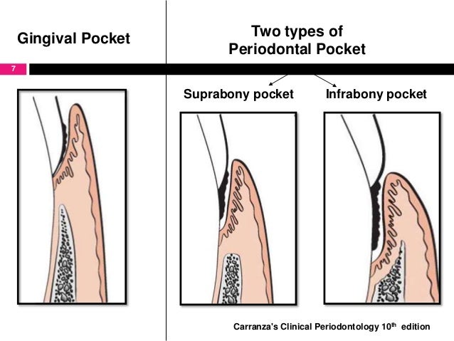 Etiopathogensis of periodontal pocket