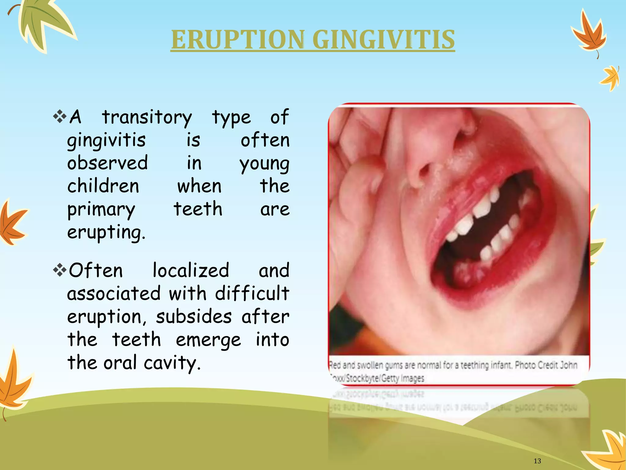 Gingival disease in childhood | PPTX