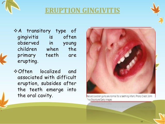 Gingival disease in childhood