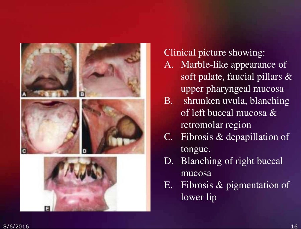 management of oral submucous fibrosis