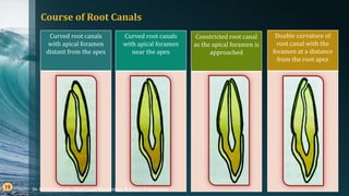 Root Canal Morphology & Access Preparation | PDF
