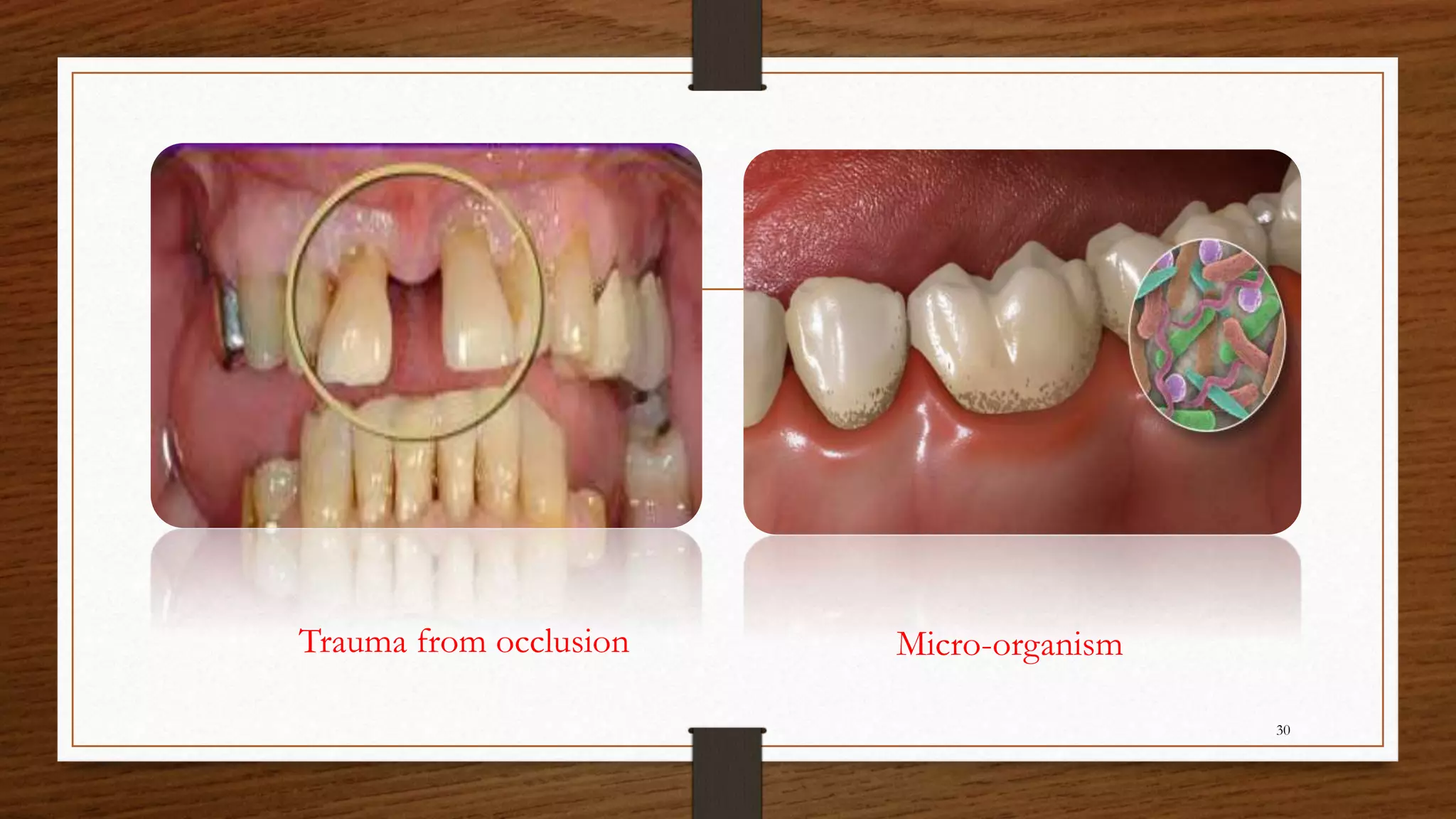 chronic periodontitis | PPTX