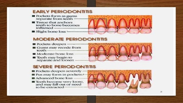 chronic periodontitis