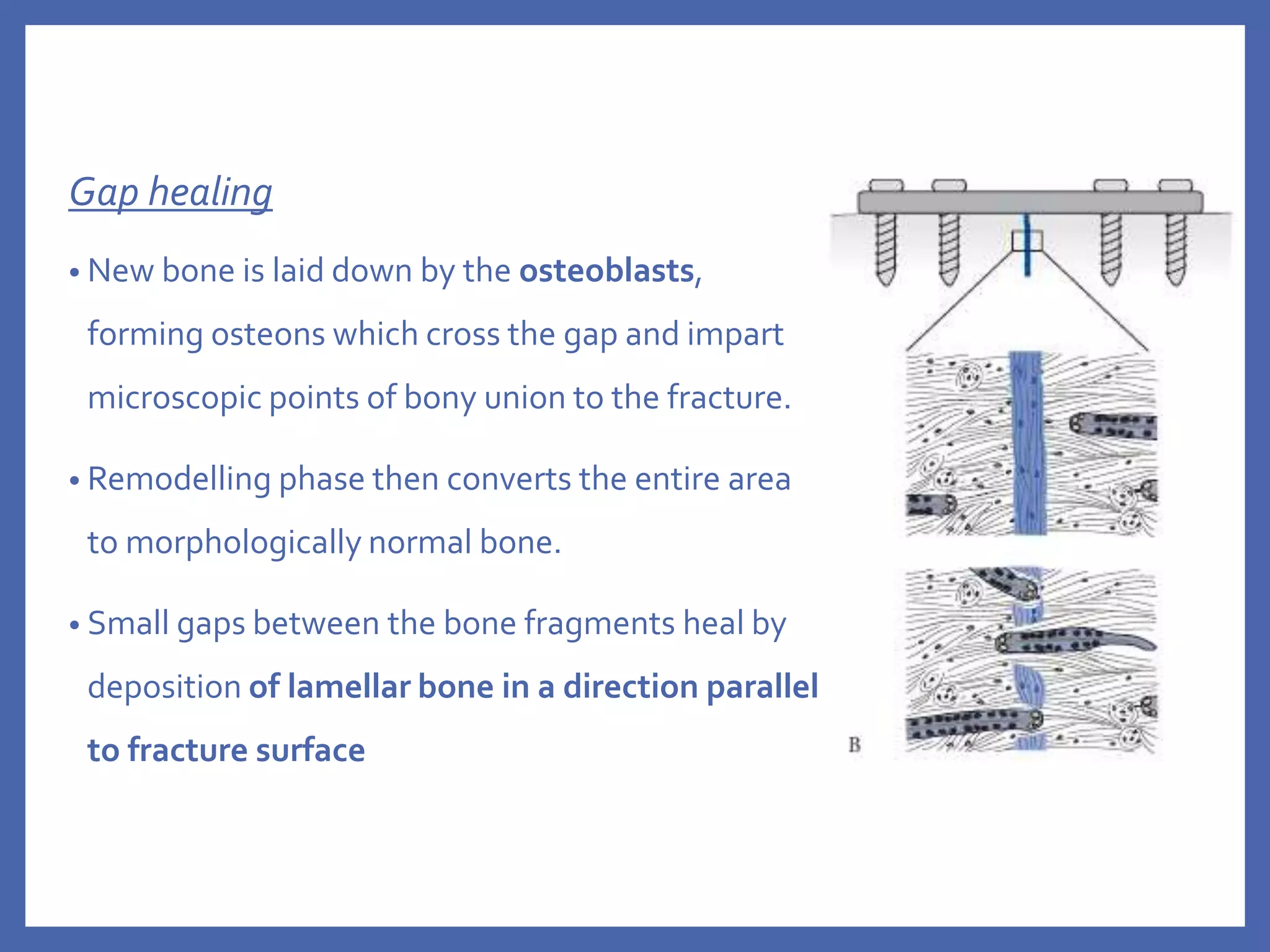 fixation systems in maxillofacial fractures | PPTX