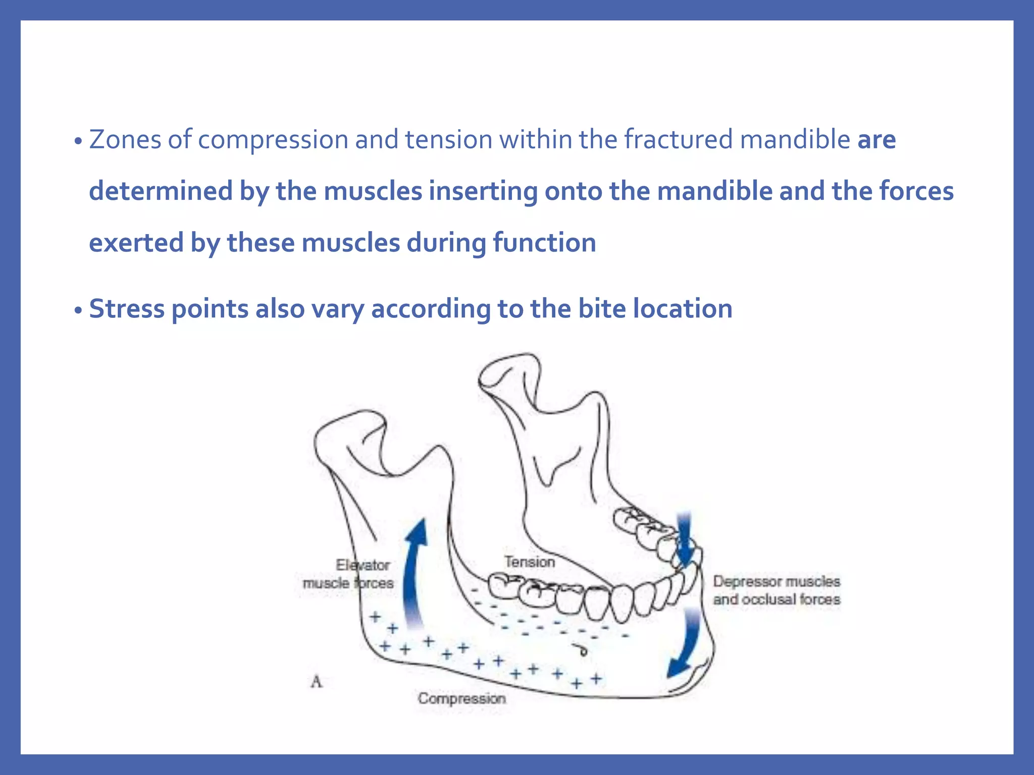 fixation systems in maxillofacial fractures | PPTX