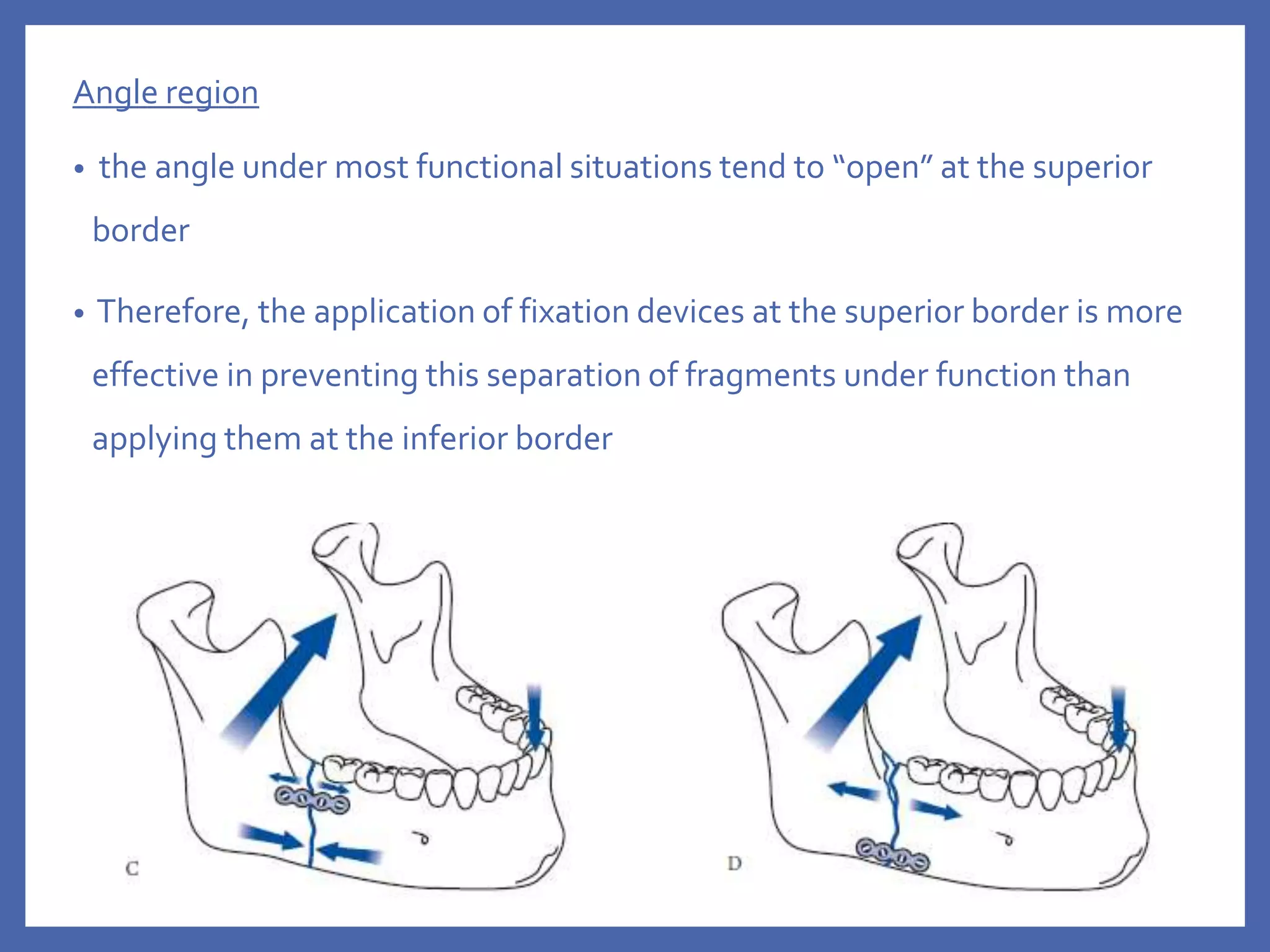 fixation systems in maxillofacial fractures | PPTX