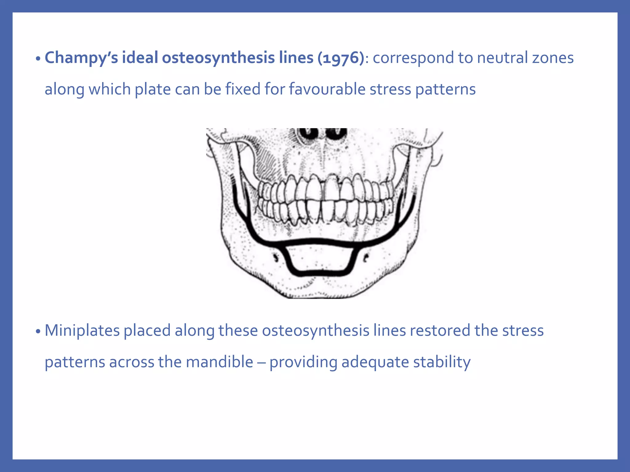 fixation systems in maxillofacial fractures | PPTX