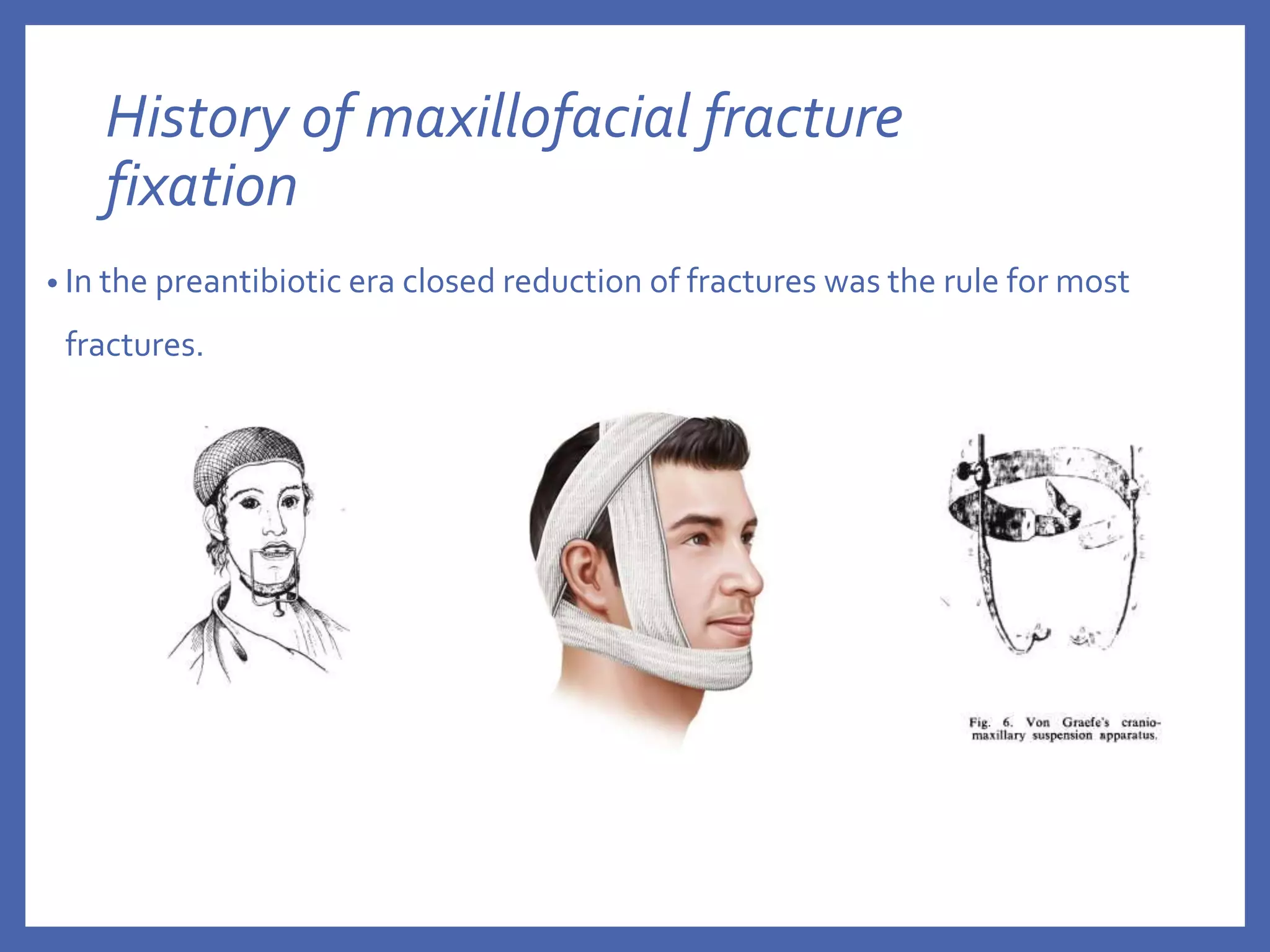 fixation systems in maxillofacial fractures | PPTX