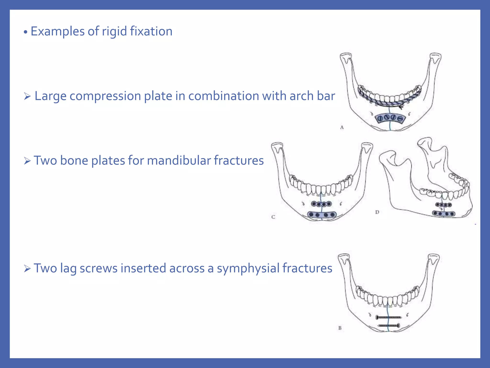 fixation systems in maxillofacial fractures | PPTX