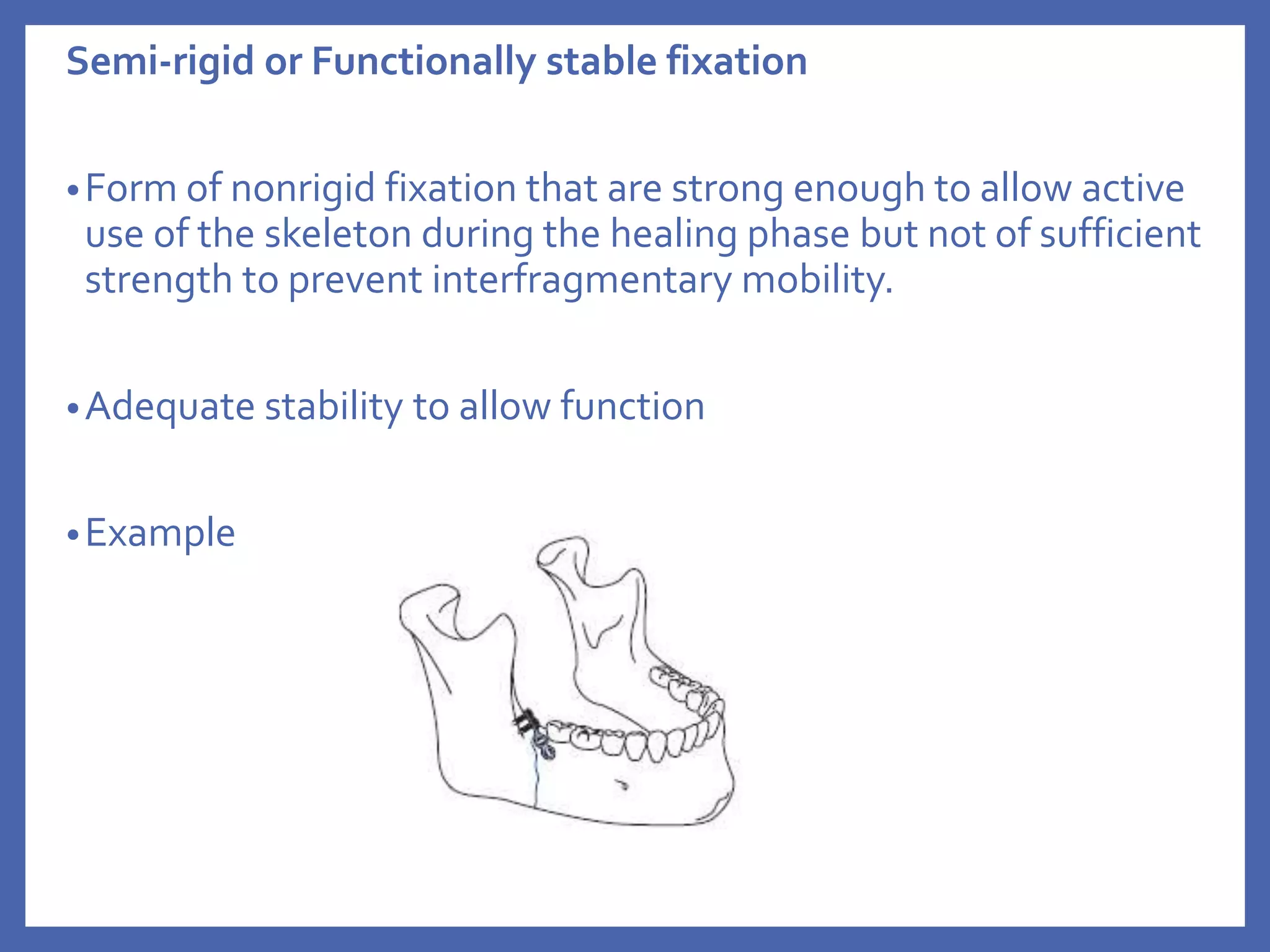 fixation systems in maxillofacial fractures | PPTX