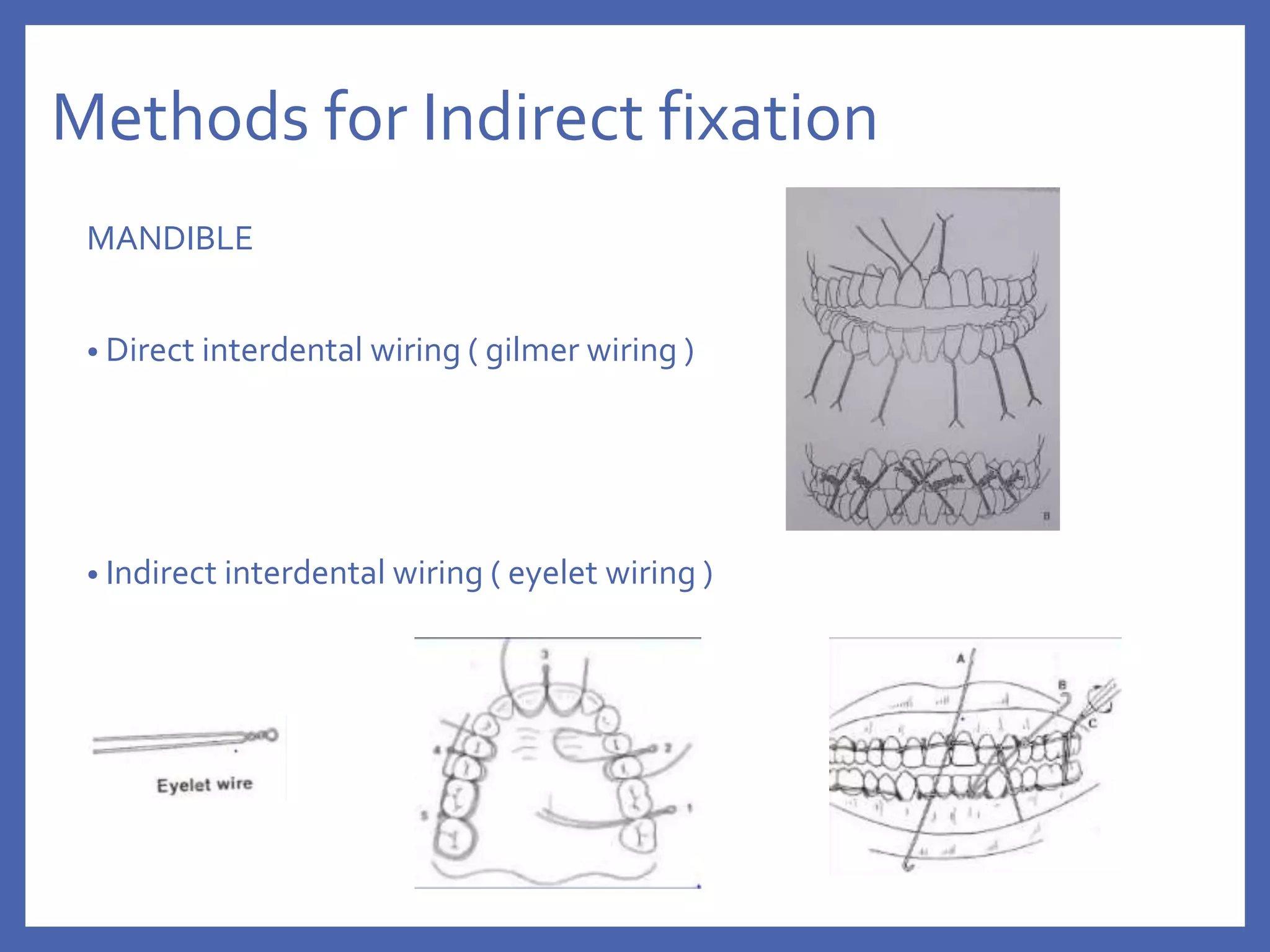 fixation systems in maxillofacial fractures | PPTX