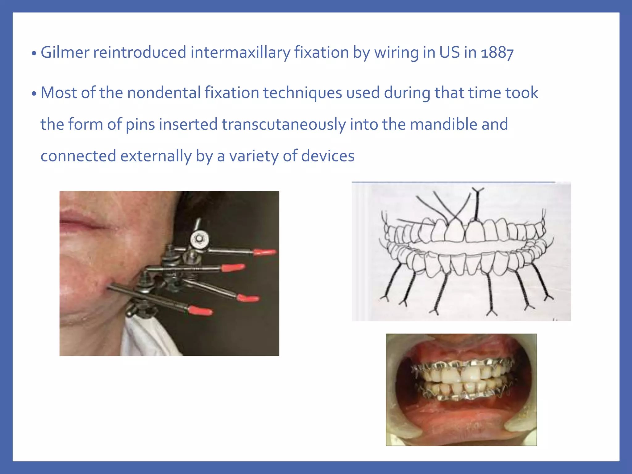 fixation systems in maxillofacial fractures | PPTX
