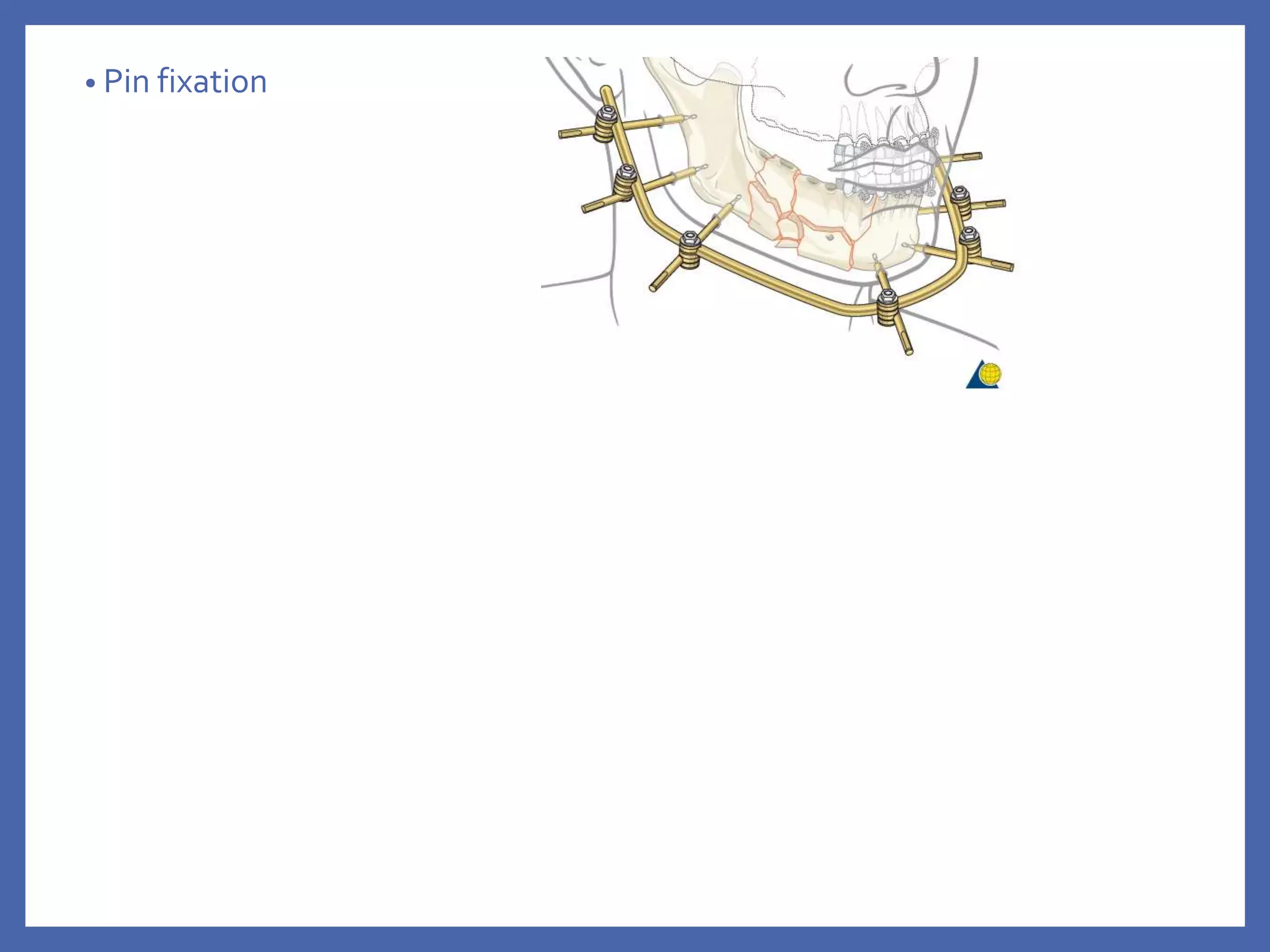 fixation systems in maxillofacial fractures | PPTX