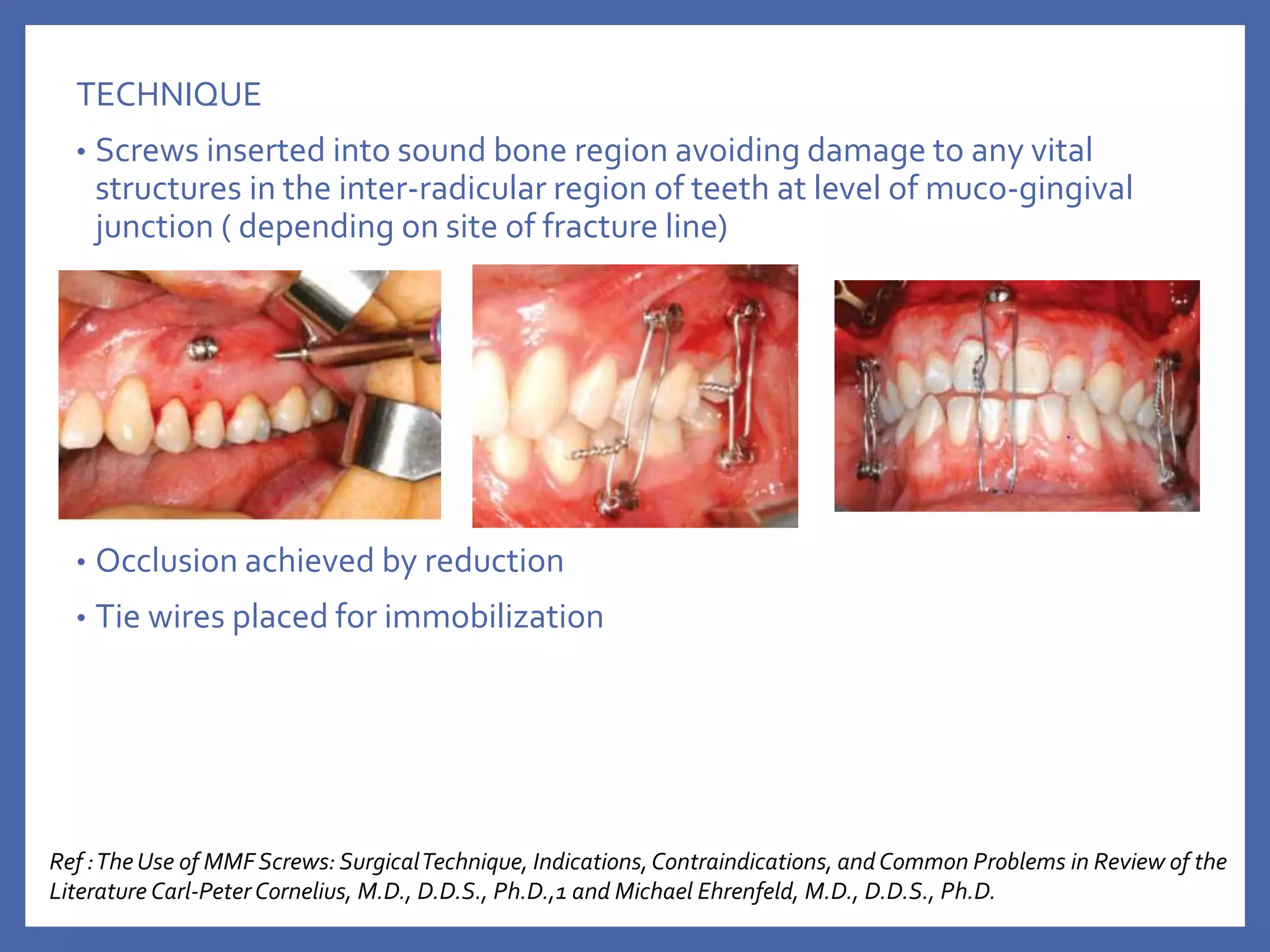 fixation systems in maxillofacial fractures | PPTX