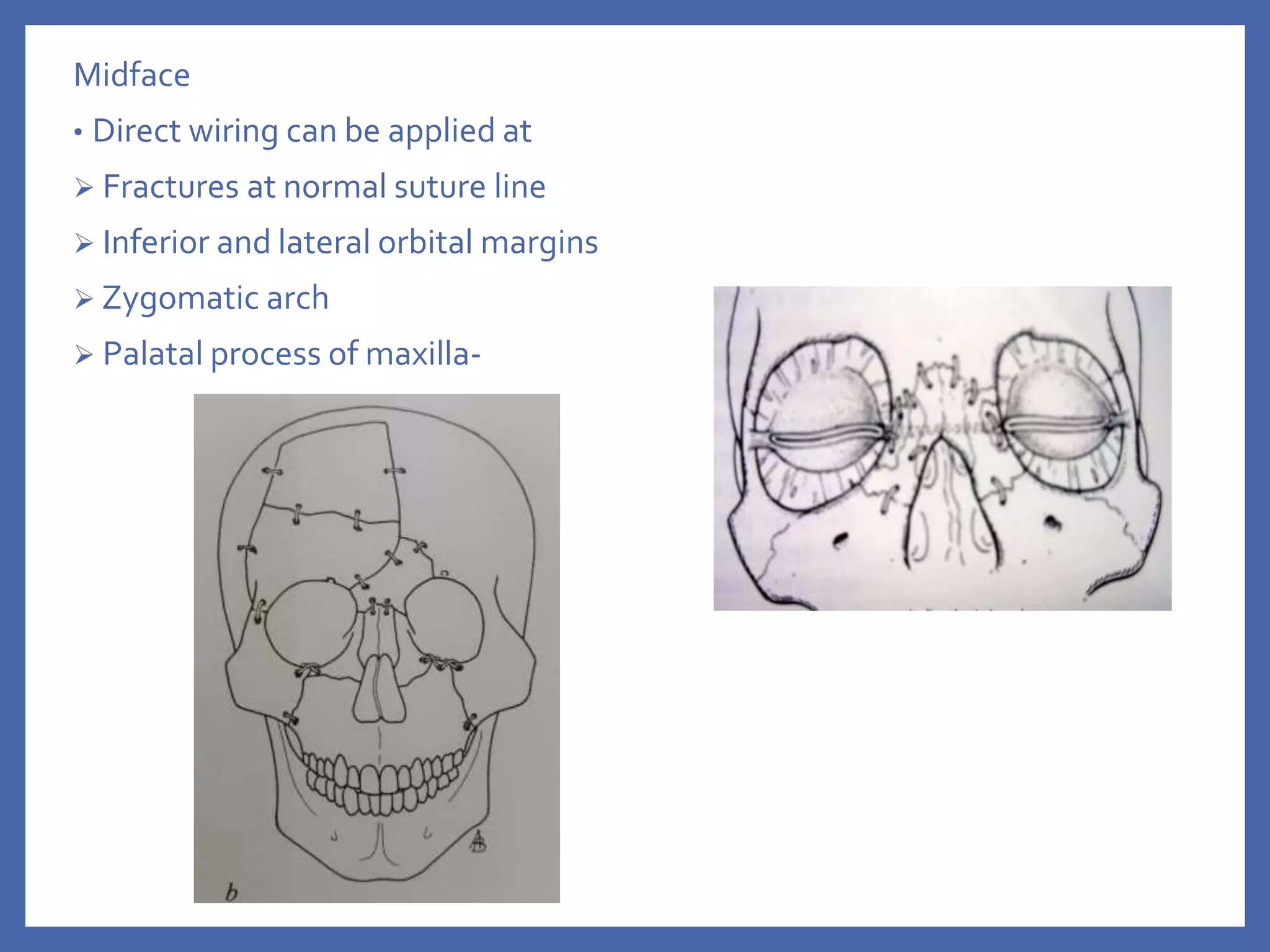 fixation systems in maxillofacial fractures | PPTX