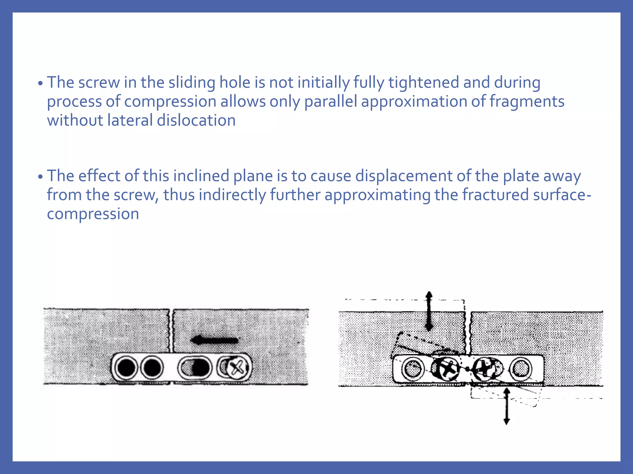 fixation systems in maxillofacial fractures | PPTX