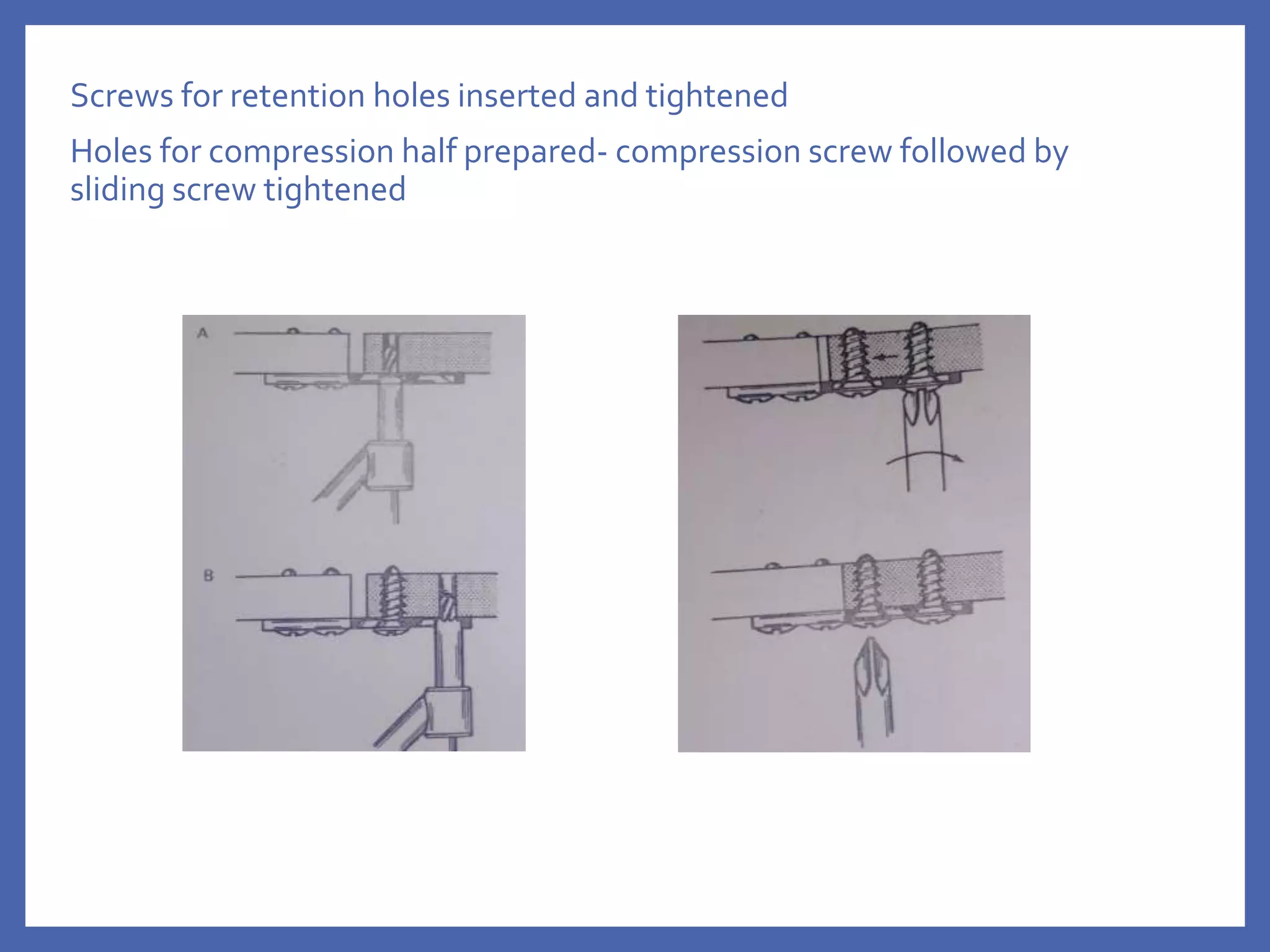 fixation systems in maxillofacial fractures | PPTX