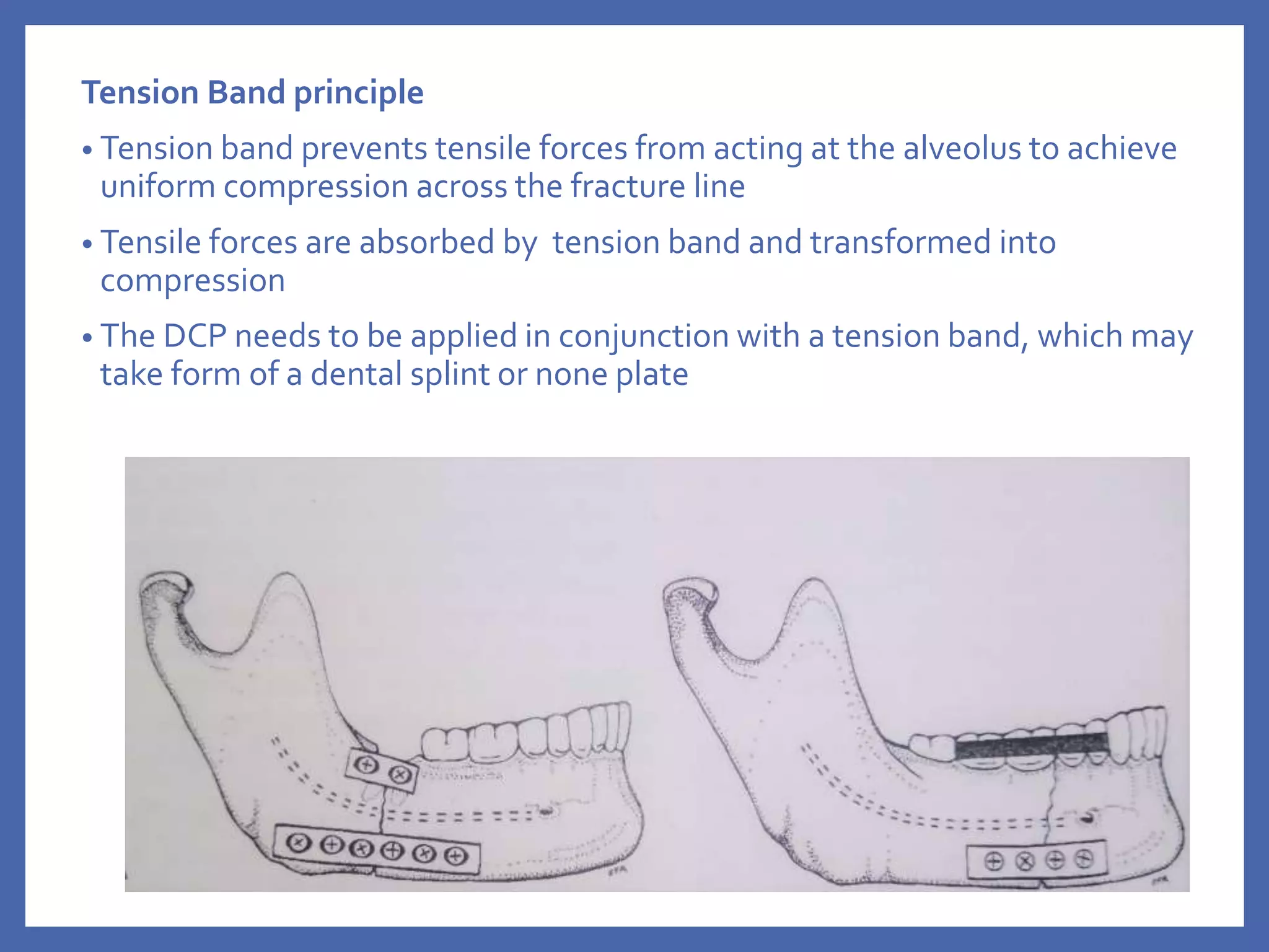 fixation systems in maxillofacial fractures | PPTX