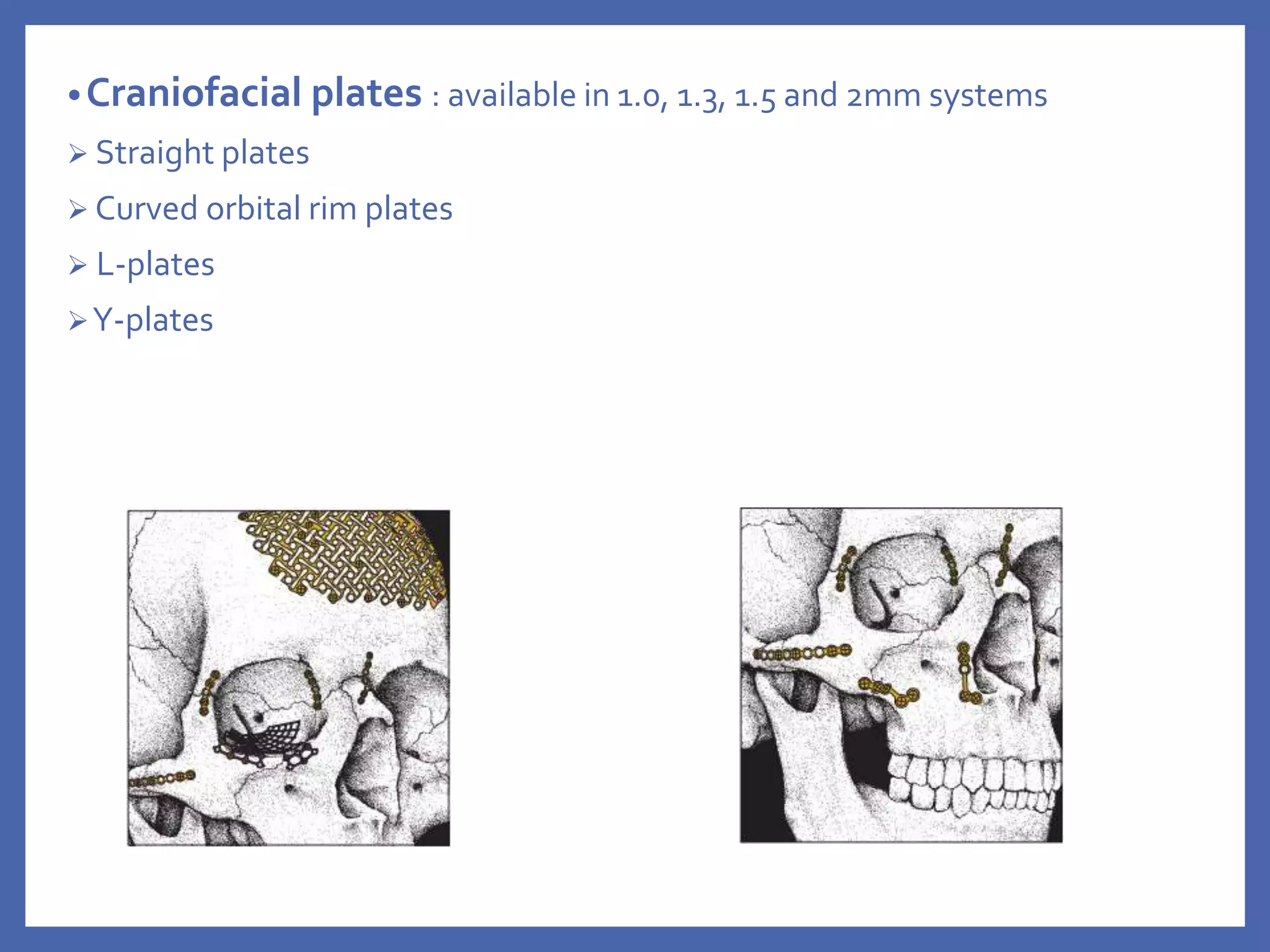 fixation systems in maxillofacial fractures | PPTX