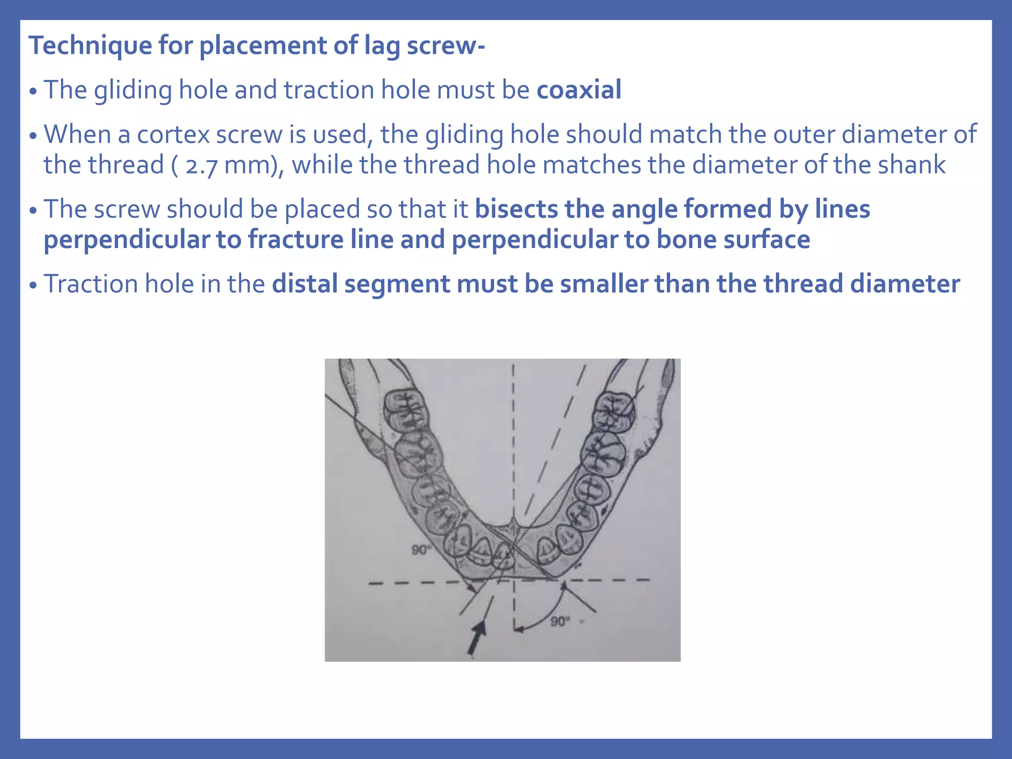 fixation systems in maxillofacial fractures | PPTX