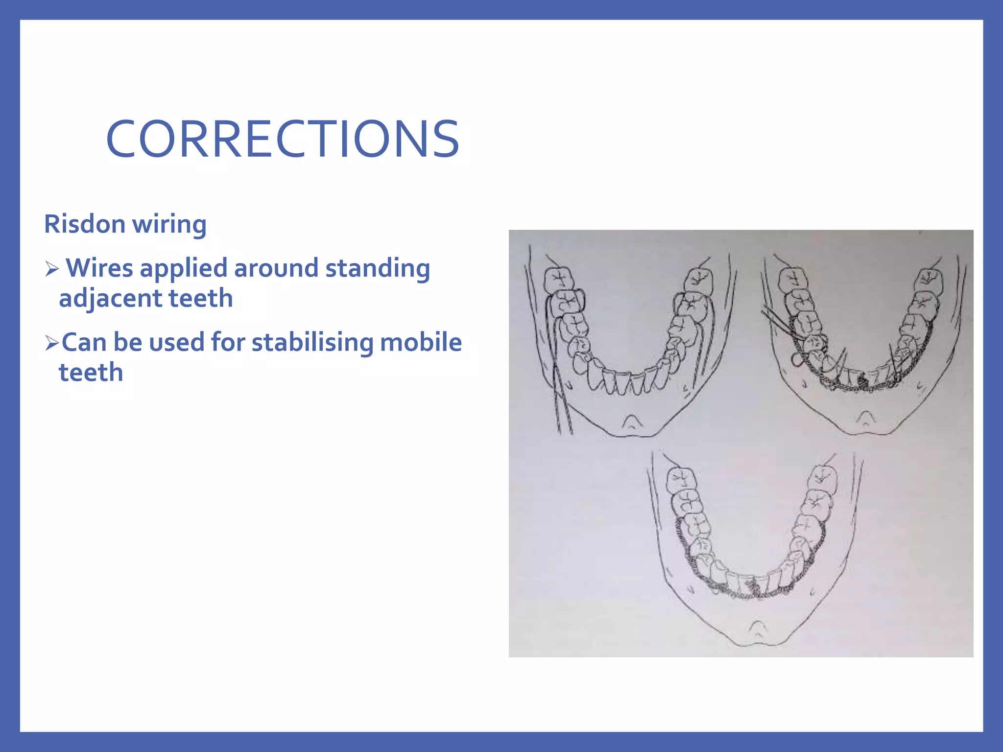 fixation systems in maxillofacial fractures | PPTX
