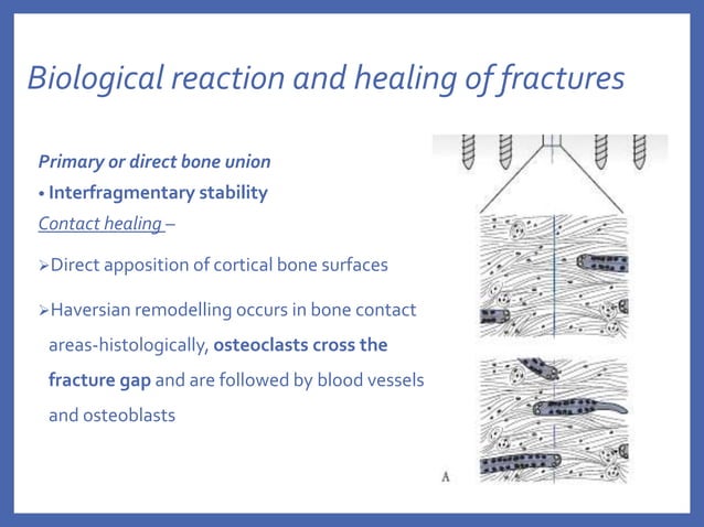 fixation systems in maxillofacial fractures | PPTX