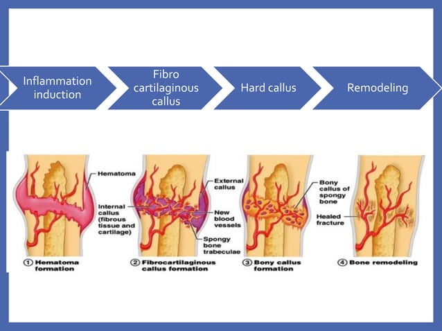 fixation systems in maxillofacial fractures | PPTX