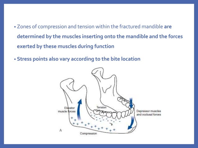 fixation systems in maxillofacial fractures | PPTX
