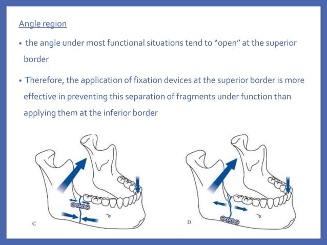 fixation systems in maxillofacial fractures | PPTX