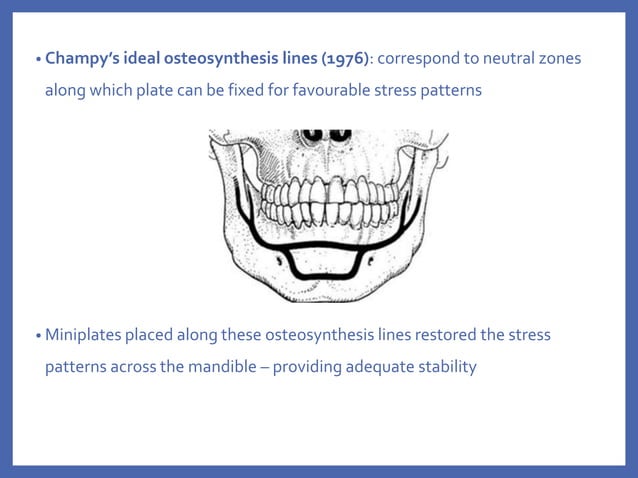fixation systems in maxillofacial fractures | PPTX