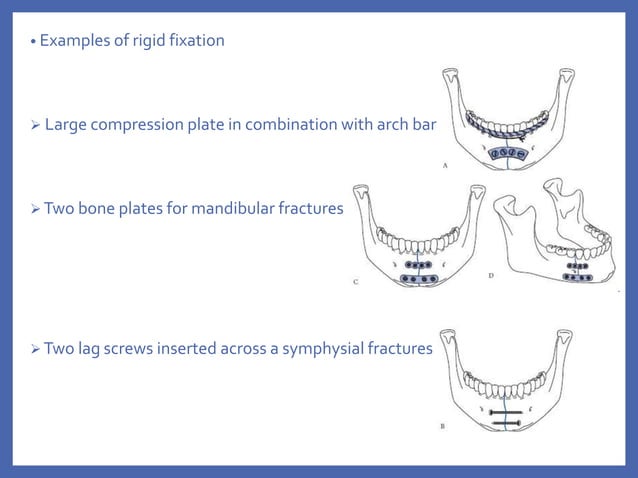 fixation systems in maxillofacial fractures | PPTX