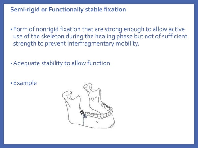 fixation systems in maxillofacial fractures | PPTX