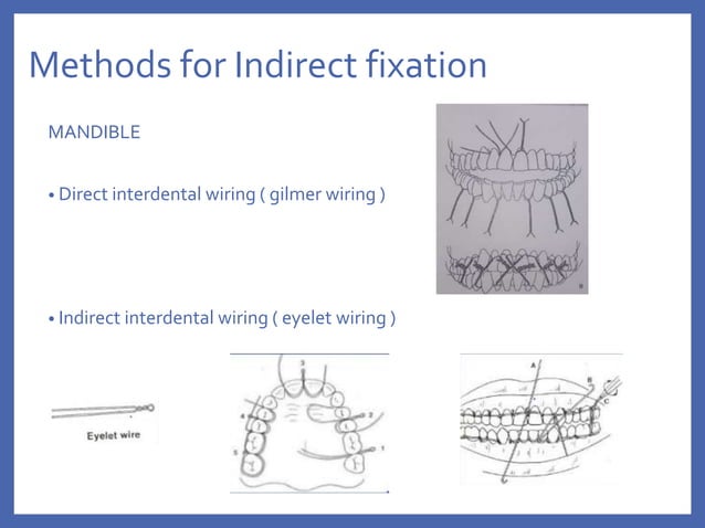 fixation systems in maxillofacial fractures | PPTX