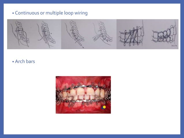 fixation systems in maxillofacial fractures | PPTX