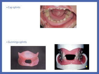 fixation systems in maxillofacial fractures | PPTX