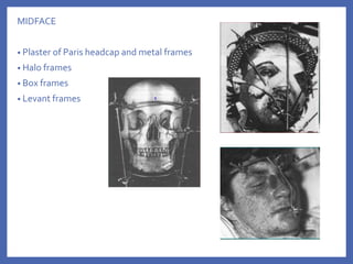 fixation systems in maxillofacial fractures | PPTX