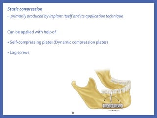 fixation systems in maxillofacial fractures | PPTX