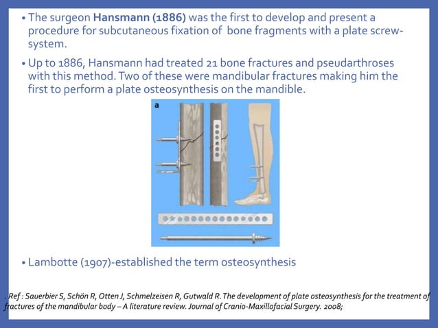 fixation systems in maxillofacial fractures | PPTX