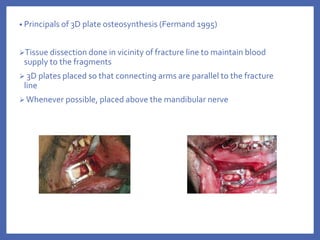fixation systems in maxillofacial fractures | PPTX