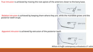 biomechanics of incisor intrusion and retraction | PPT