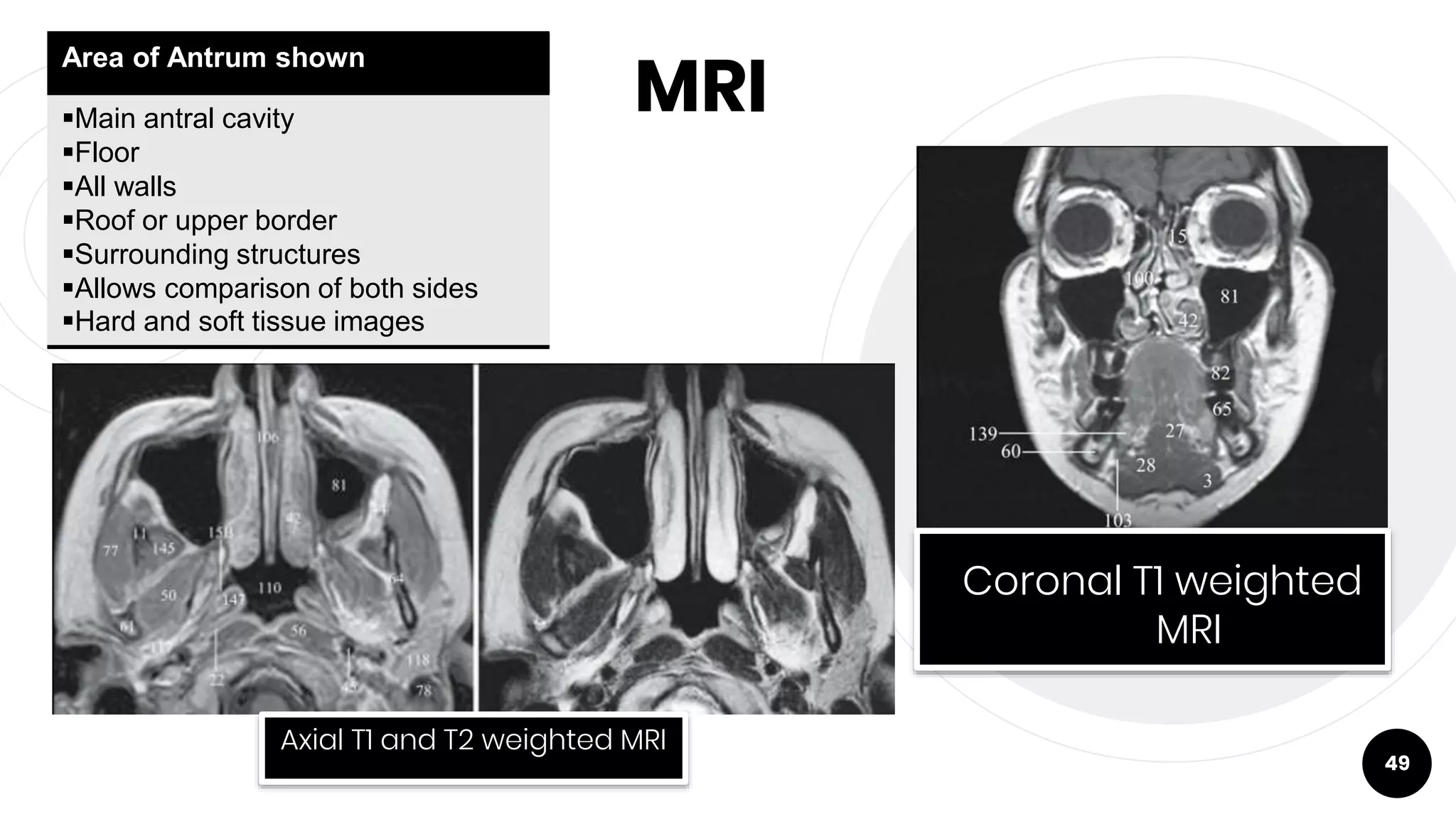 Maxillary sinus imaging | PPTX