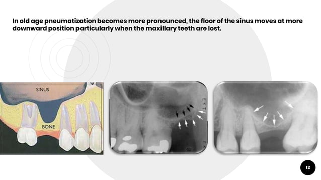 Maxillary sinus imaging | PPTX | Ear, Nose and Throat Conditions ...