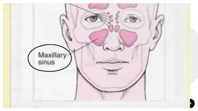 Maxillary sinus imaging | PPTX | Ear, Nose and Throat Conditions ...