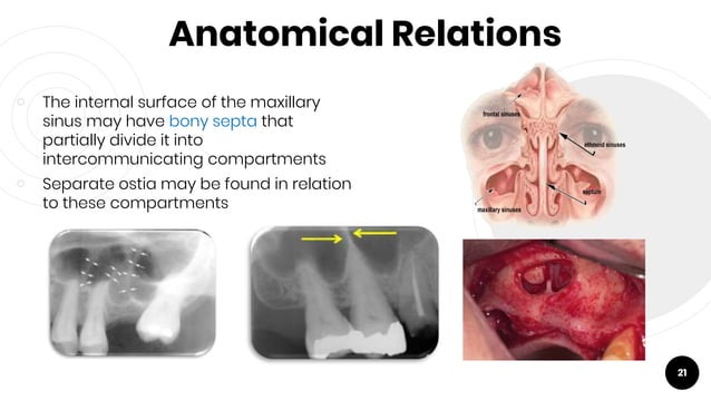 Maxillary sinus imaging | PPTX | Ear, Nose and Throat Conditions ...