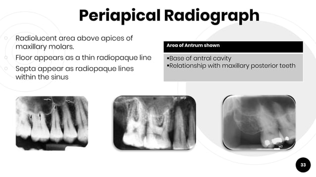 Maxillary sinus imaging | PPTX | Ear, Nose and Throat Conditions ...